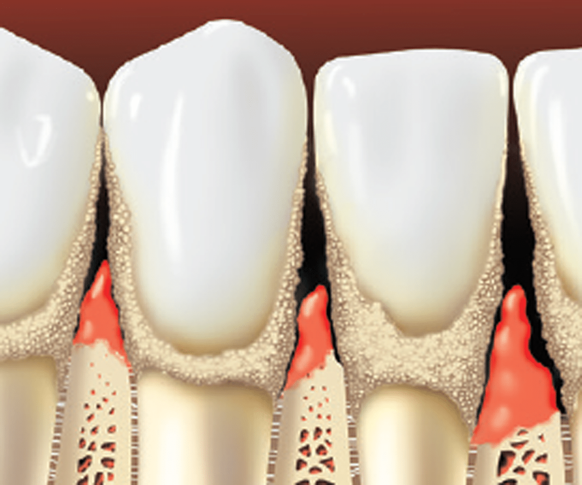 Periodontal (Gum) Disease Treatment - Metzger Dentistry