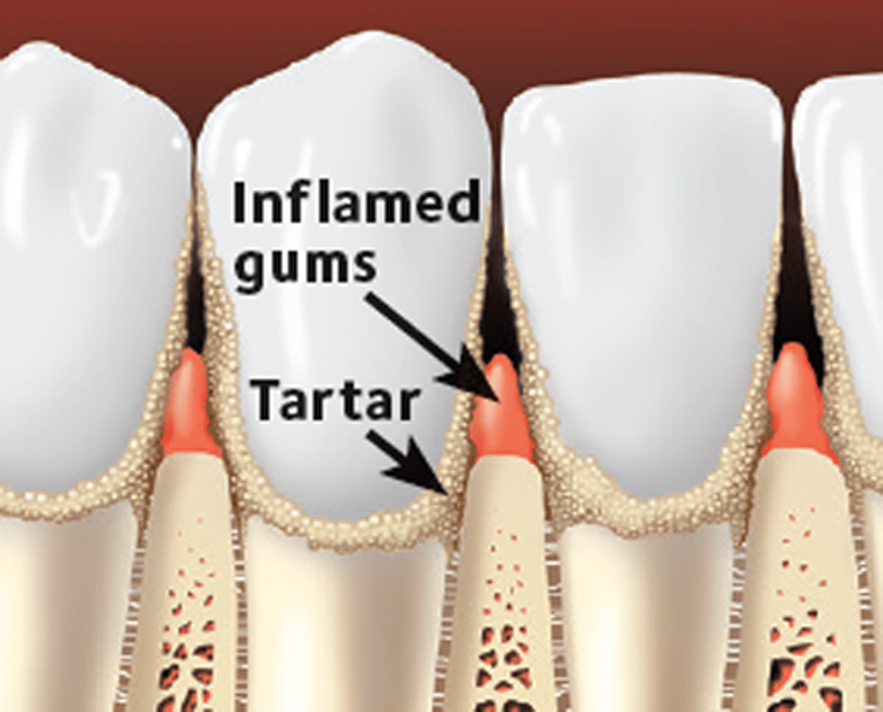 Periodontal (Gum) Disease Treatment - Metzger Dentistry